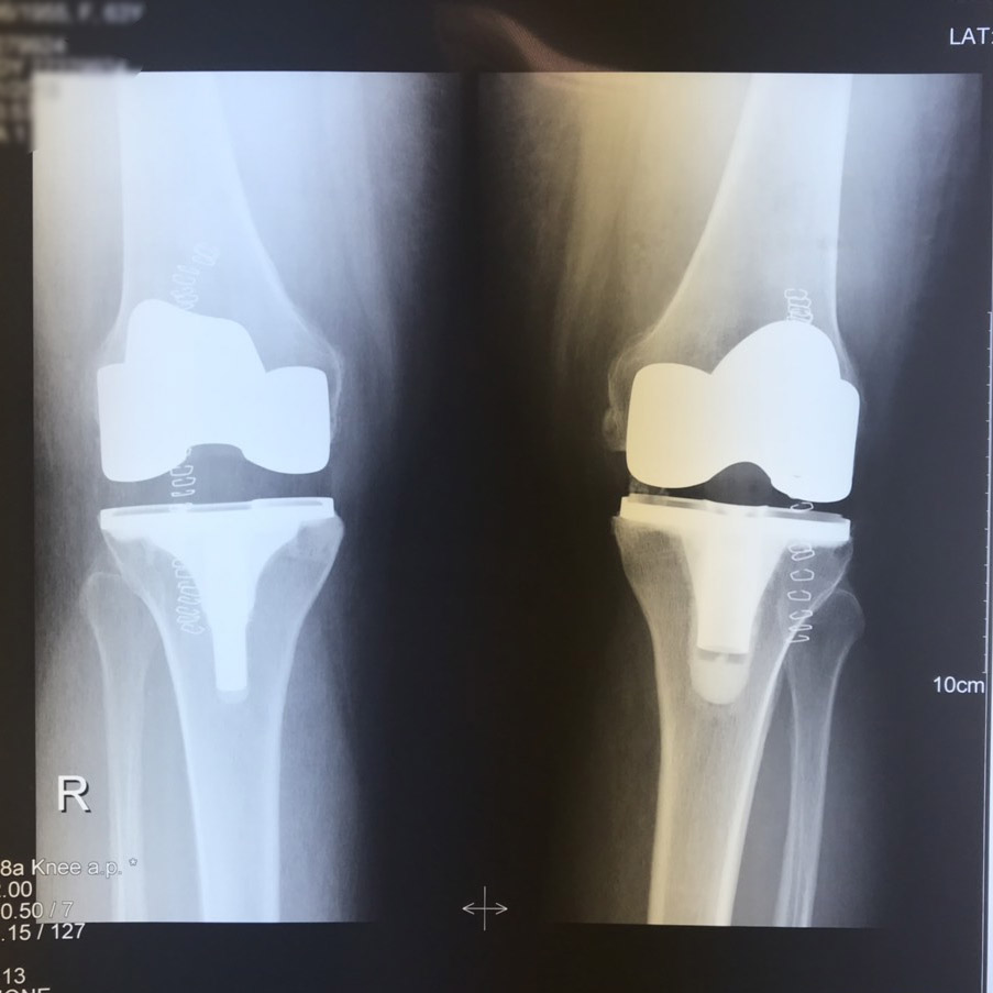 Αρθροπλαστική γόνατος MIS - MIS Knee and Hip - Ορθοπαιδική Χειρουργική ...